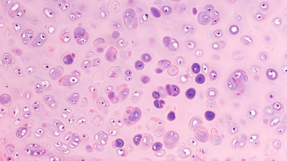 Bioprinting patient specific cartilage to treat articular joint lesions ...