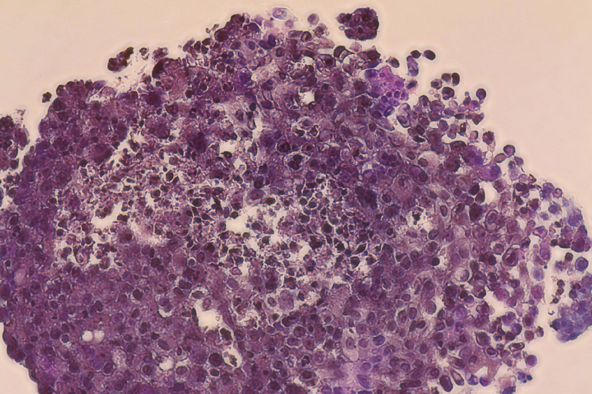 Bioprinting Breast Cancer Models for Personalized Medicine - CELLINK