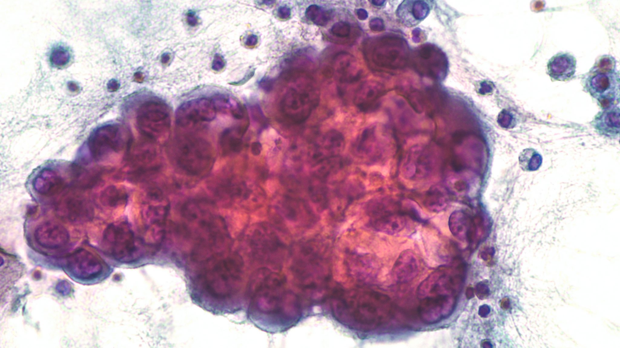 3D Bioprinted Tumor Model for Immuno-oncology Applications - CELLINK